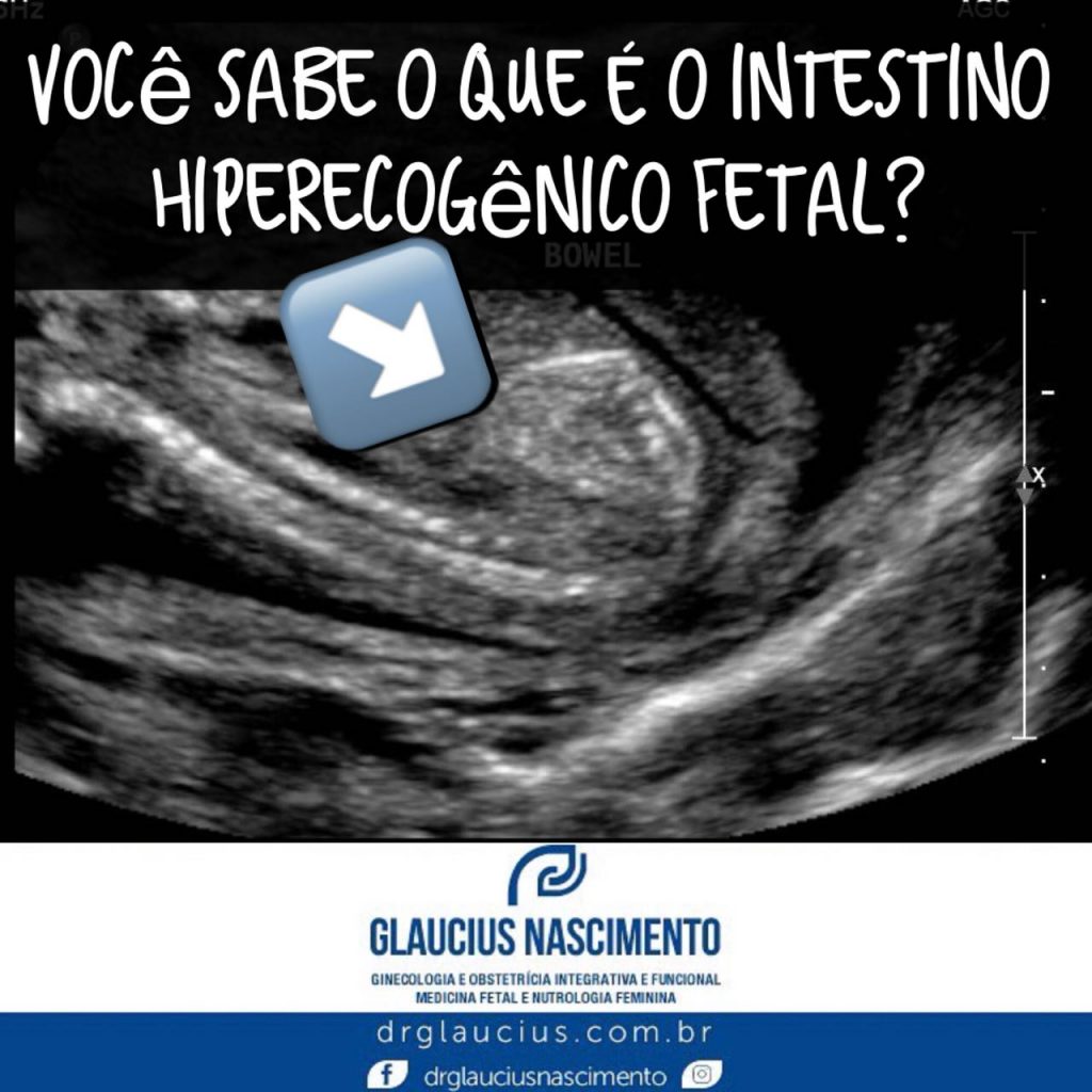 INTESTINO HIPERECOGÊNICO FETAL – Dr. Glaucius Nascimento